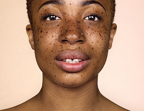 Why Do We Have Freckles On Our Face? - Frolicious | Deine Afro Haare ...
